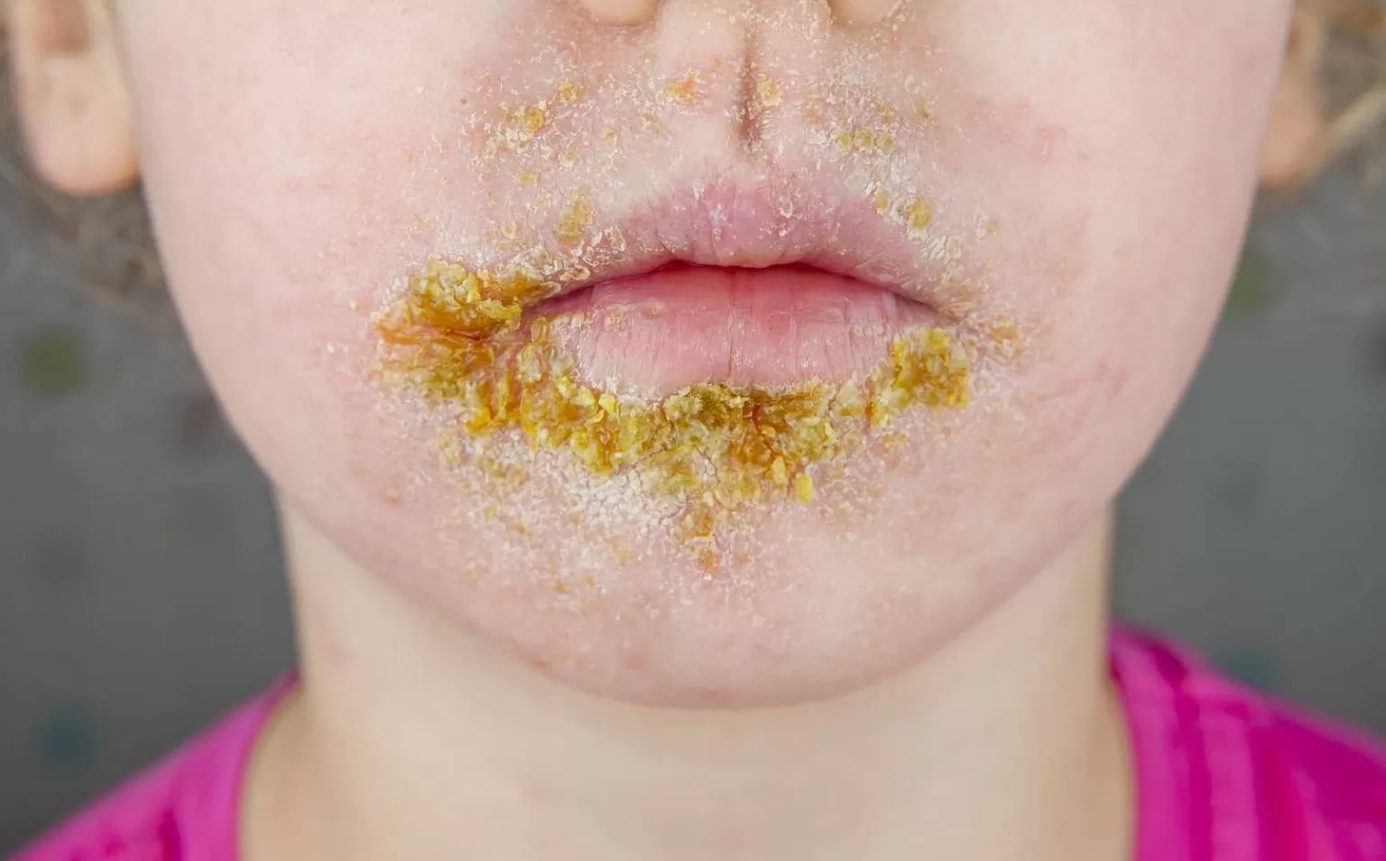 Impetigo Contagiosa | Impetigo Rash | Impetigo On Lips | Dermatim